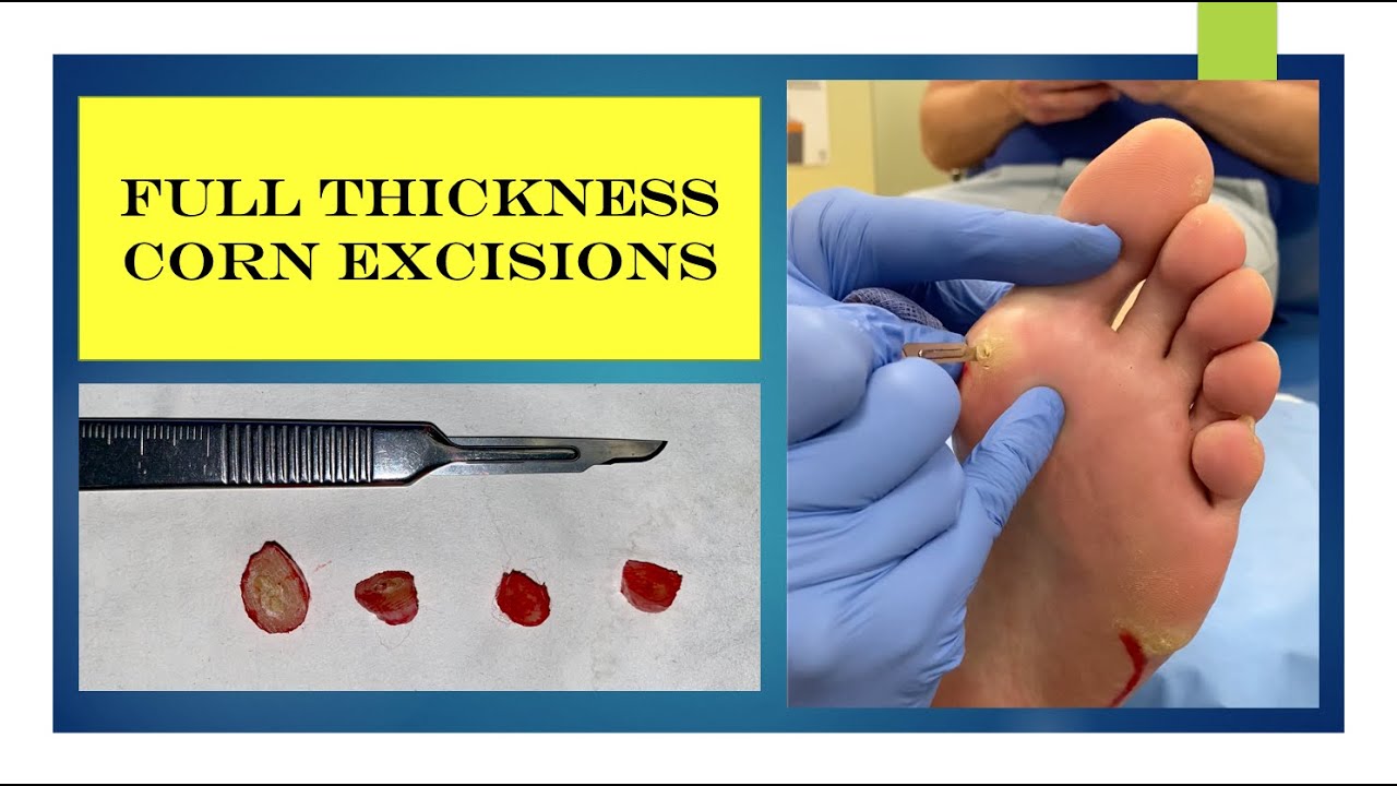 Video - full thickness corn excision - YouTube