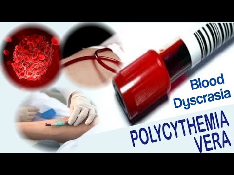 Polycythemia Vera | Blood Dyscrasia | Causes, Symptoms, Diagnosis and ...