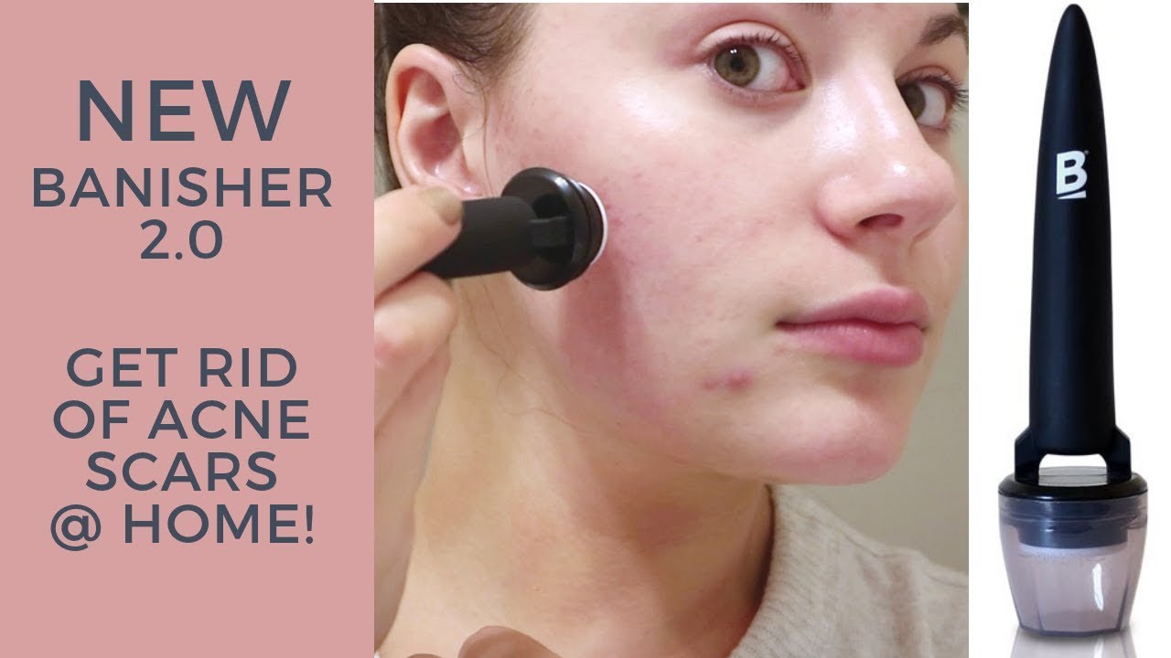 HOW TO GET RID OF ACNE SCARS AT HOME | BANISHER 2.0 - YouTube