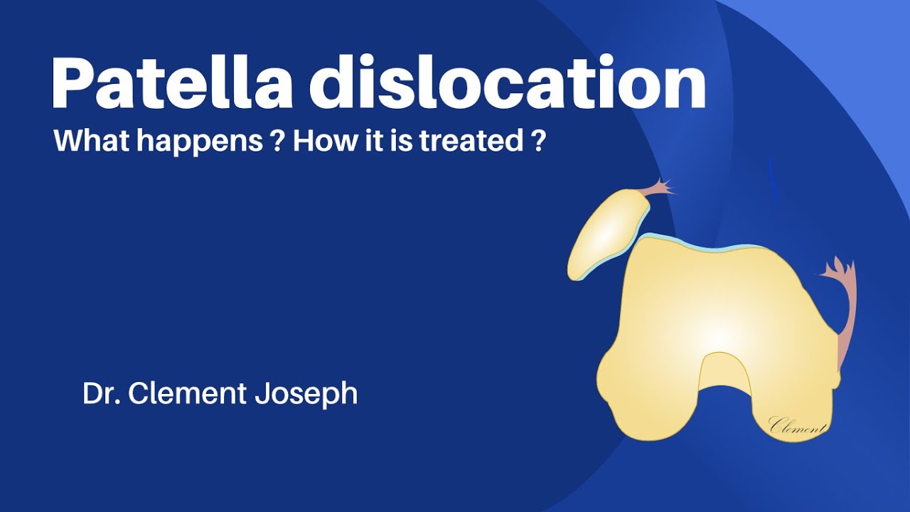 Patella dislocation risk factors & treatment - YouTube
