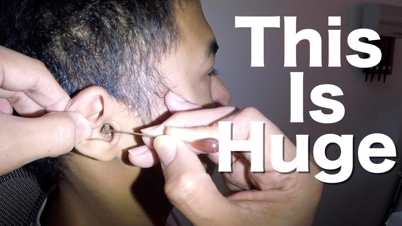 Young Man's Earwax Chunk Removed using Hydrogen Peroxide - YouTube