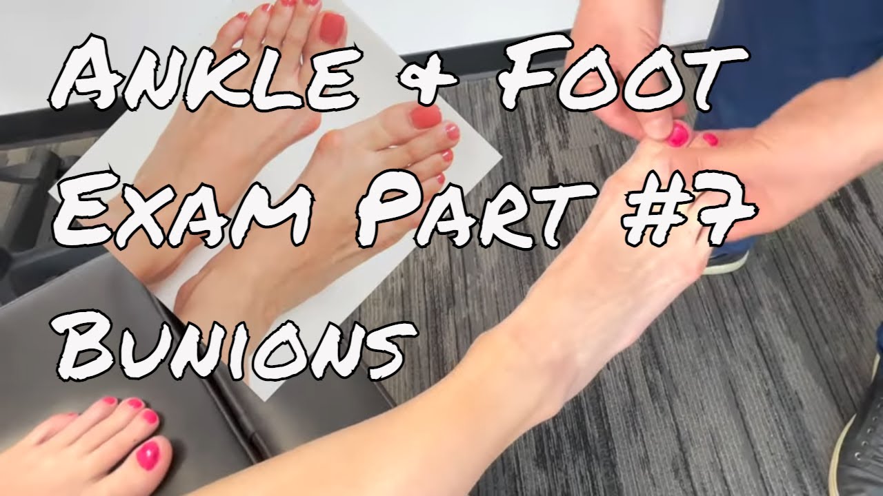 Ankle & Foot Exam Part #7 - Bunions (Hallux Valgus) - YouTube