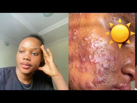 How To Use Retinol Without Experiencing Skin Purging - YouTube