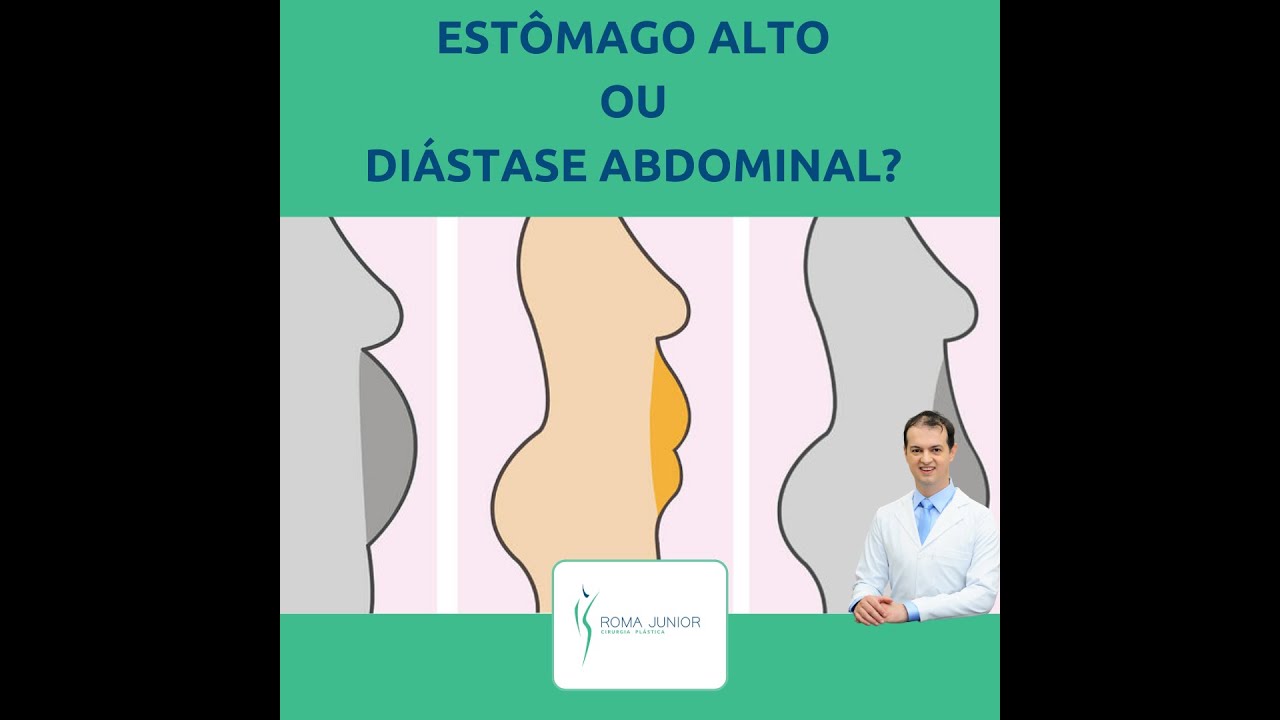 Tenho estômago alto ou diástase abdominal? - YouTube