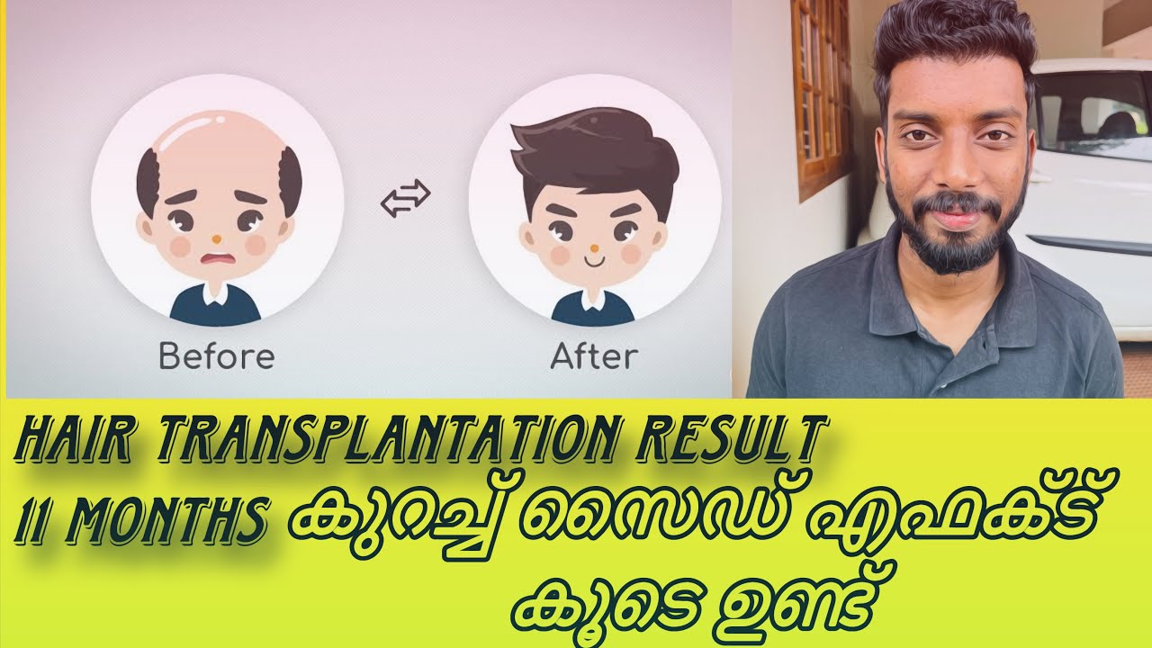 Hair Transplantation Result 11 months | ഉണ്ടാവുന്ന സൈഡ് എഫക്ട് | safvan pullara | - YouTube