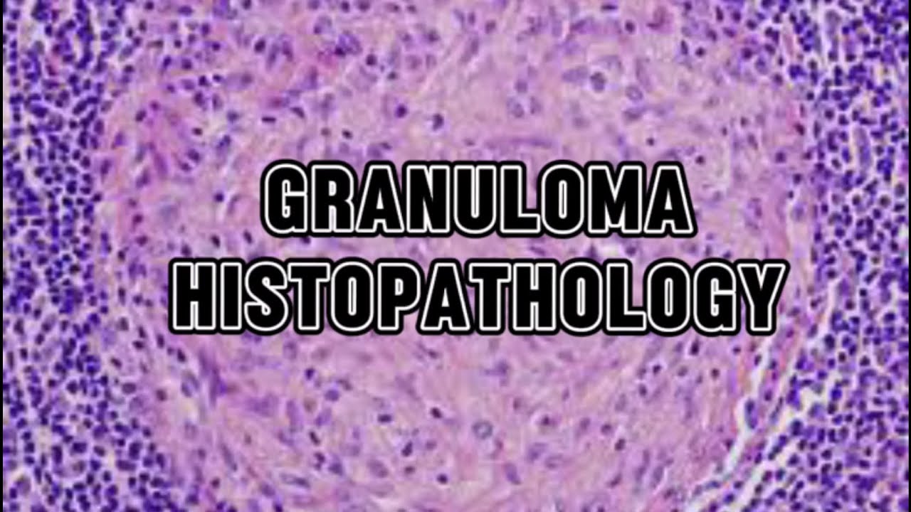 GRANULOMA | HISTOPATHOLOGY AND MORPHOLOGY - YouTube