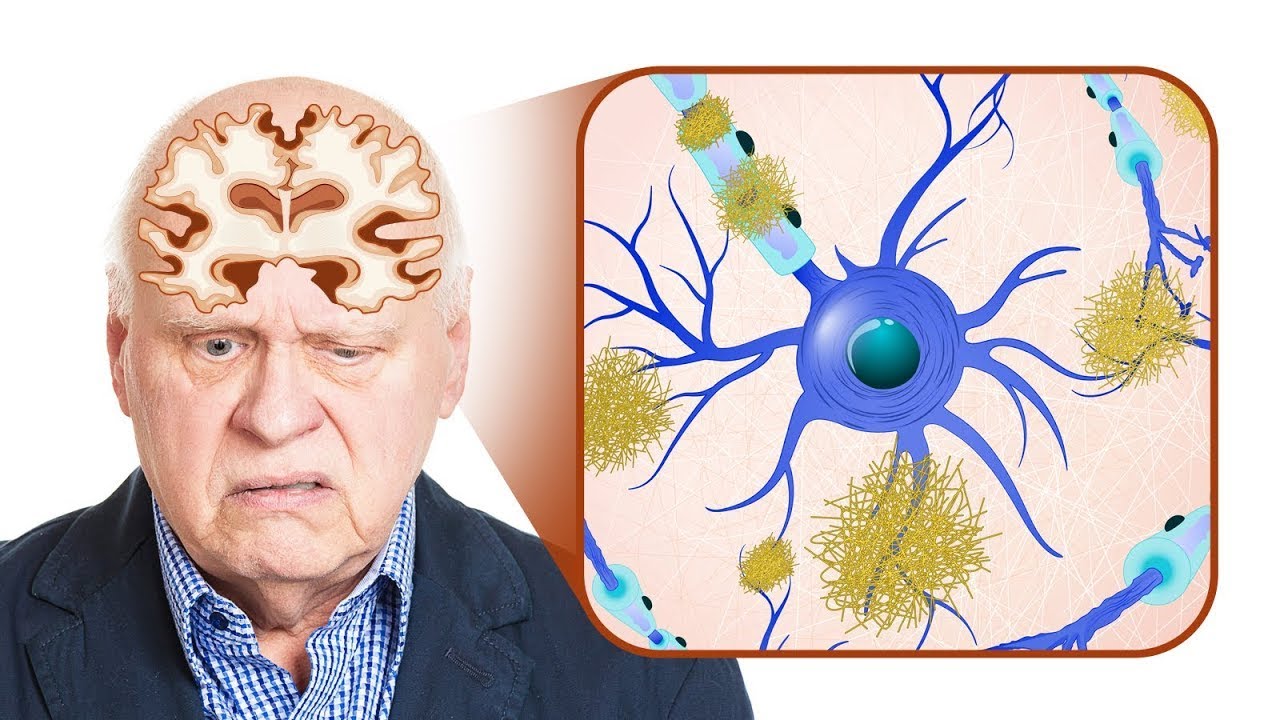 Genetically At Risk For Alzheimer s Disease DO THIS YouTube genetically-at-risk-for-alzheimer-s-disease-do-this-youtube