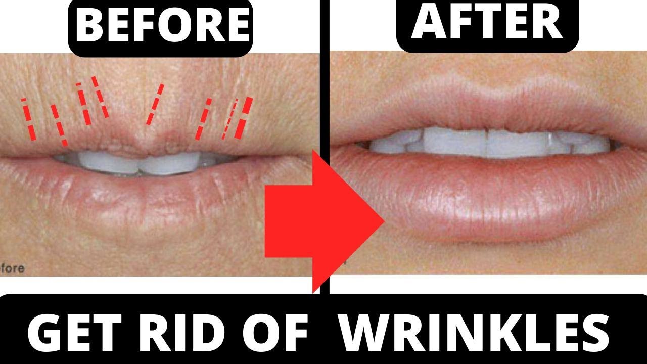 2 Effective Exercises to Smooth Smile Lip Lines & Lip Wrinkles ...
