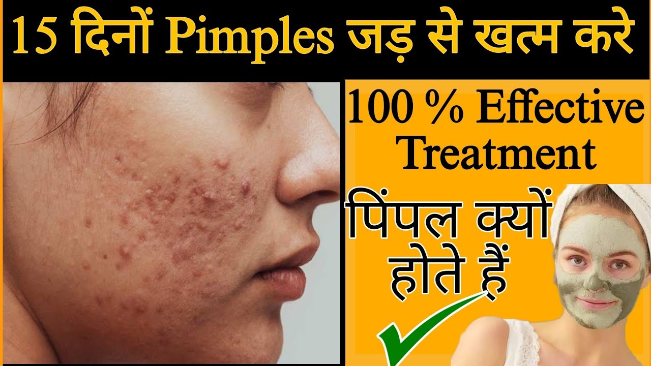 Pimples Kyu Hote Hai / Pimple kaise Theek kare / How To Treat Acne ...
