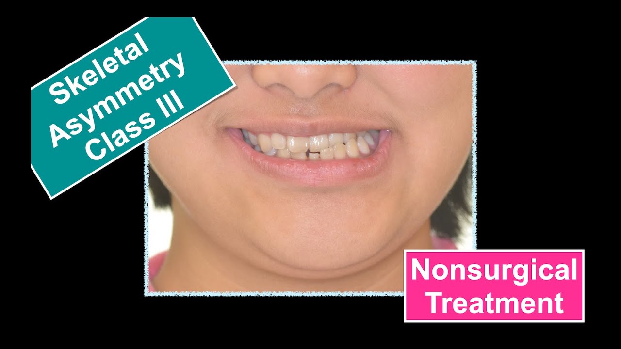 Nonsurgical treatment of skeletal asymmetrical Class III Malocclusion ...