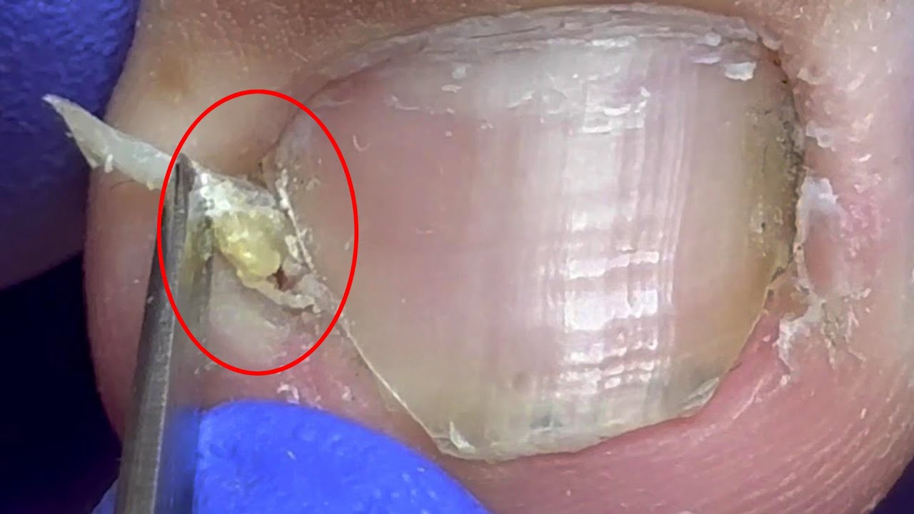 Wow~ Slowly dig out the hooks under the toenails and give the lady a ...