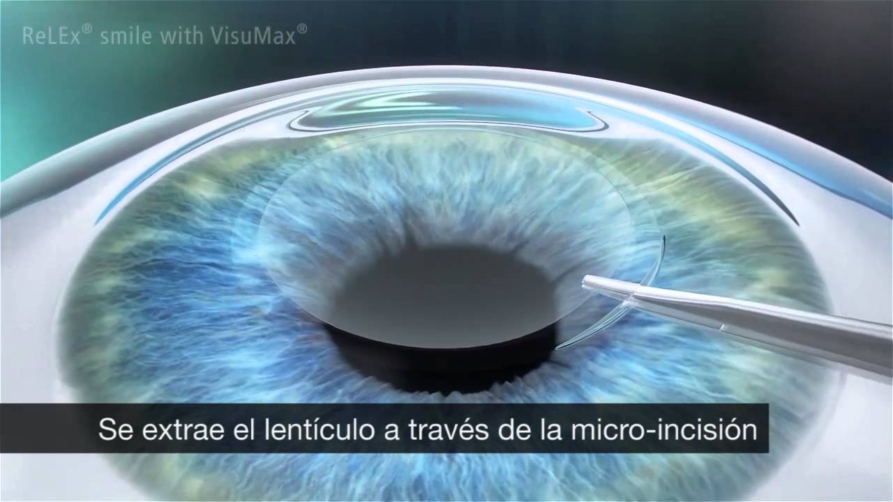 Cirugía ReLEx Smile resumida en 3 pasos - YouTube