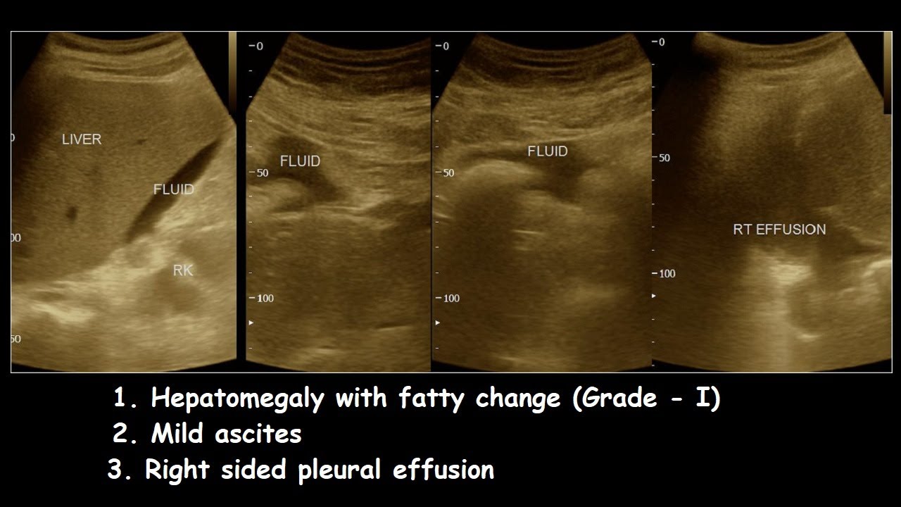 Mild ascites | Right sided pleural effusion | Ultrasound | Report ...