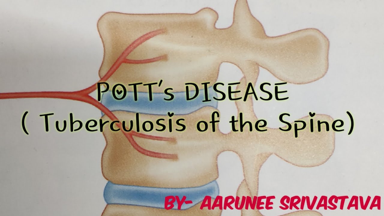 Tuberculosis of the Spine (POTT’s DISEASE) - YouTube