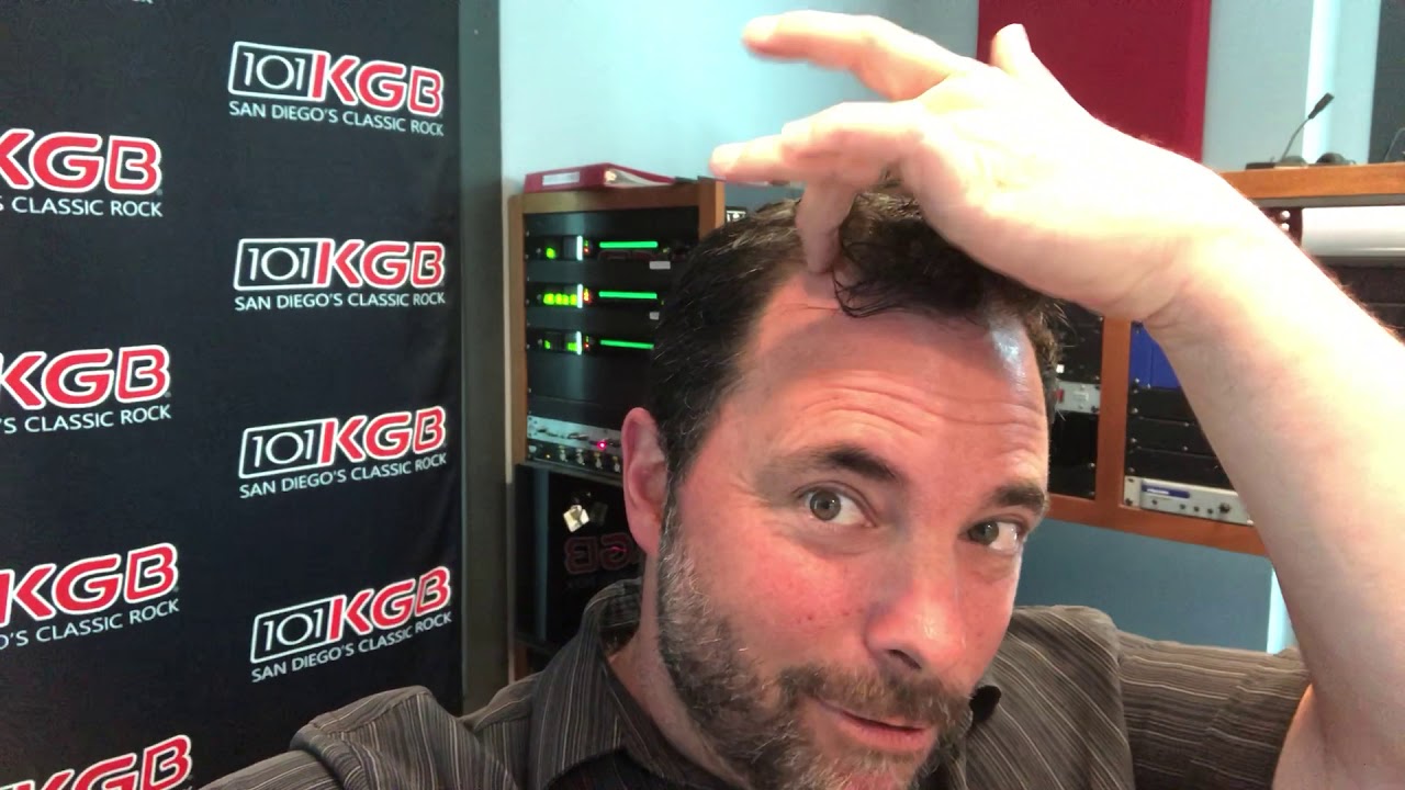 Hair Transplant San Diego Testimonial - Clint August from 101.5 KGB San ...