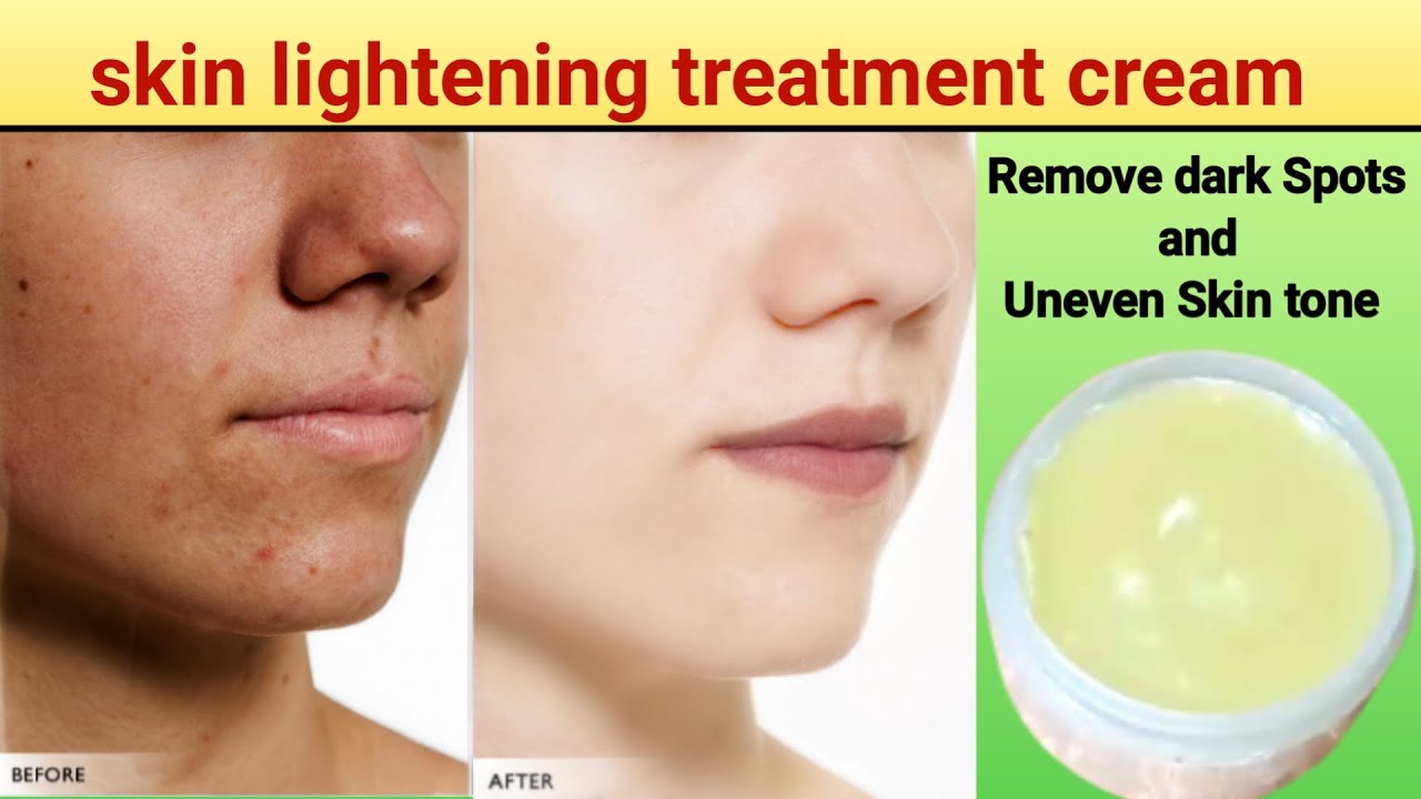 HomeMade Potato Cream | Remove Dark Spots Pigmentation & Uneven Skin ...