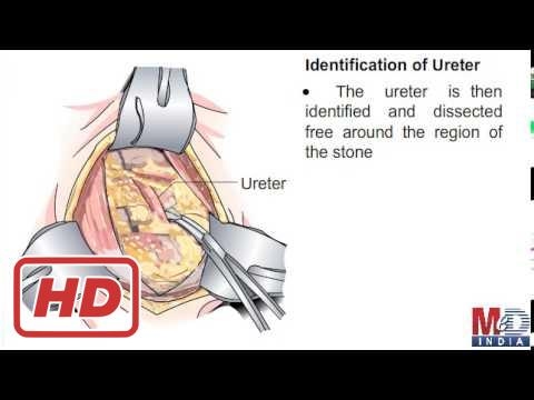 Open ureterolithotomy - YouTube