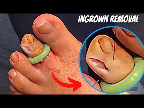 TREATMENT for INFECTED INGROWN TOENAIL by A Podiatrist surgery * How to ...