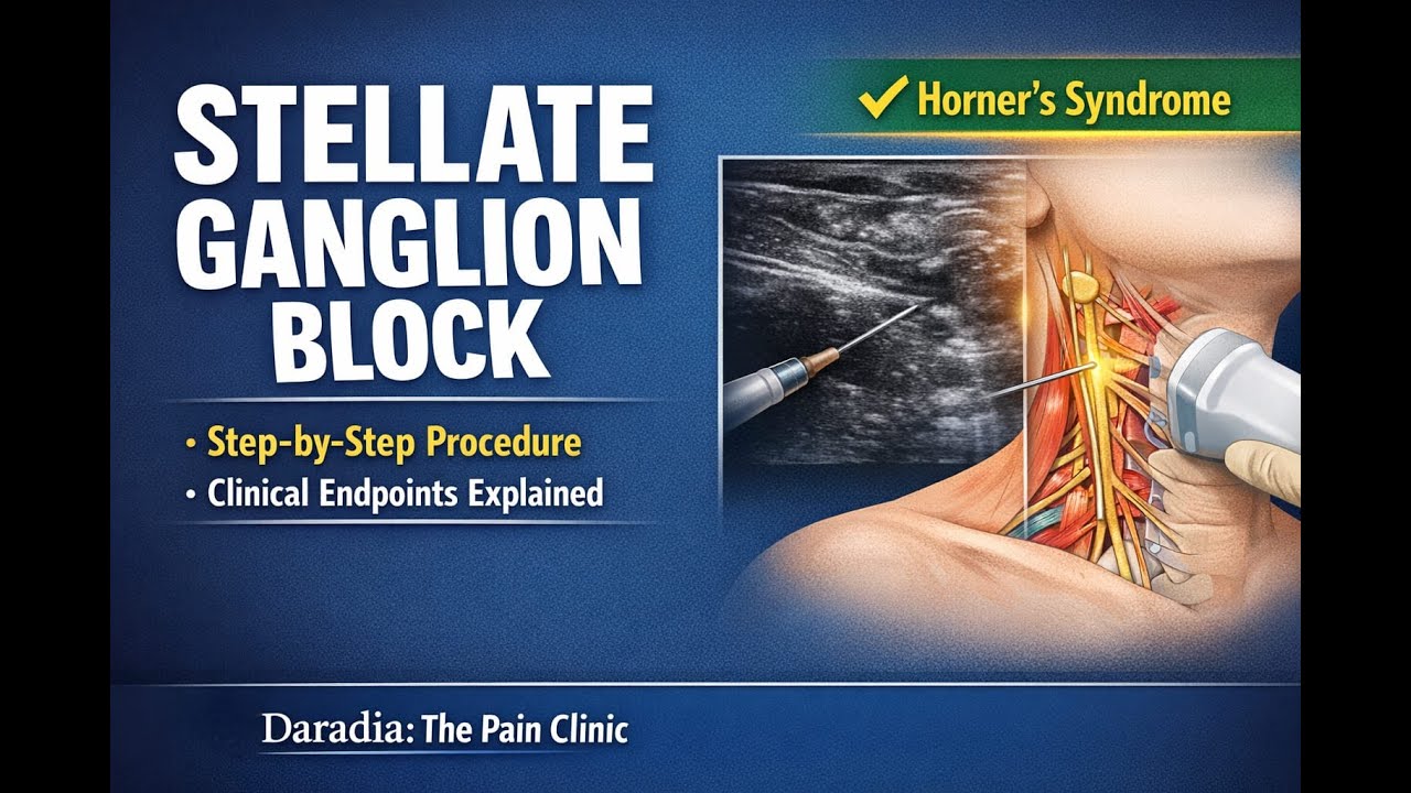 Stellate Ganglion Block: Technique, Anatomy, and Clinical Endpoints ...