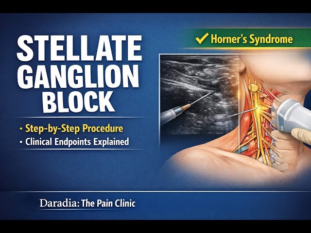 Stellate Ganglion