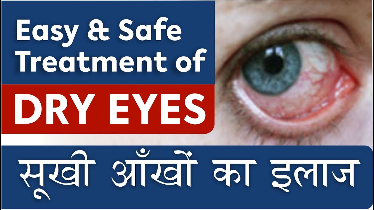 Easy & homely Treatment of Dry Eye syndrome Disease | Sookhi Aank ka ...