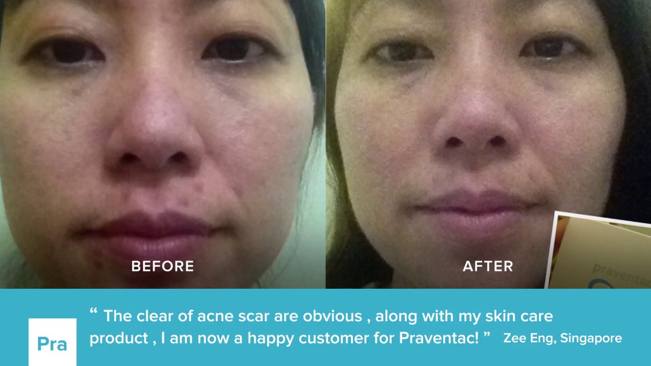 PRAVENTAC™ Acne Supplement Review #2 | Results - Customer Before ...