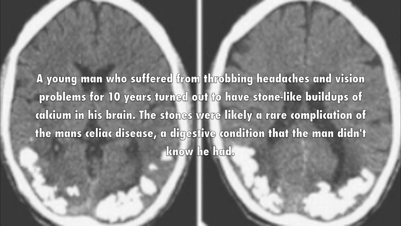 5 Bizarre Medical Cases - YouTube