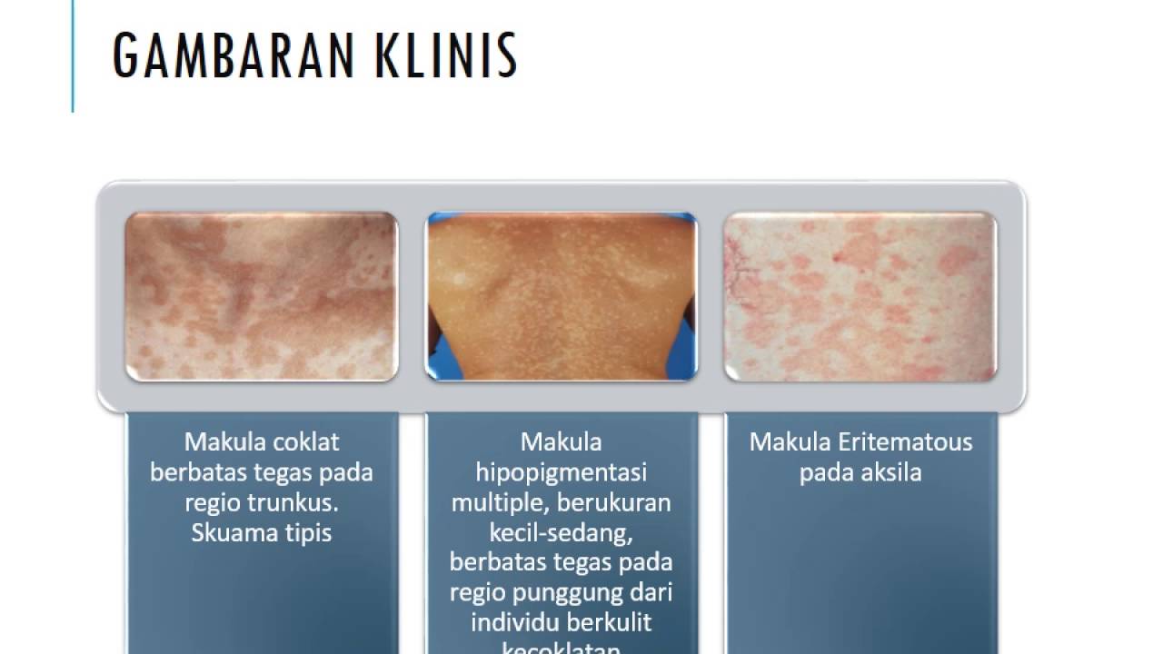 Pitiriasis Versicolor oleh Adya Sitaresmi - YouTube