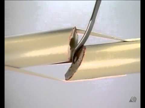 ORIF(open reduction internal fixation) - YouTube