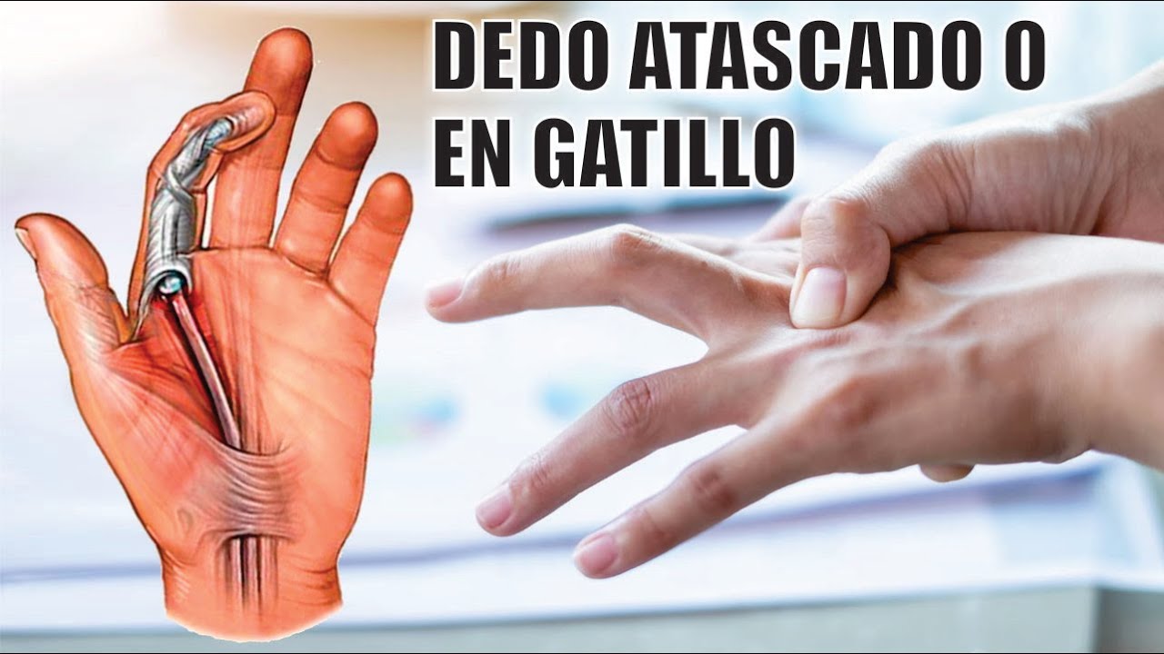 DEDO ATASCADO 🤟🏼 DEDO en GATILLO o en RESORTE 🤟🏼 Qué es y cómo se trata ...