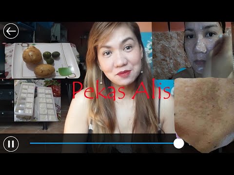 SOLUSYON SA PEKAS ACNE MARKS BUTAS BUTAS NA MUKHA DARK SPOTS REVIEW ...