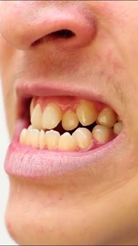 3 Interesting Facts about Invisalign Worth Remembering - YouTube