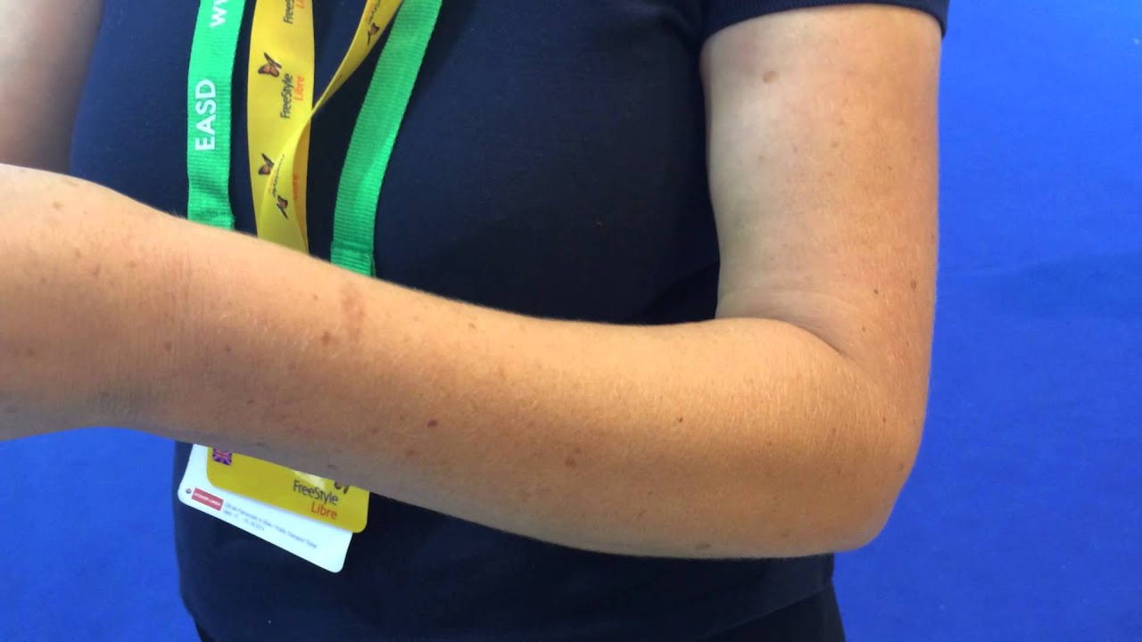 flash-glucose-monitoring-no-finger-pricks-no-pains-no-needles