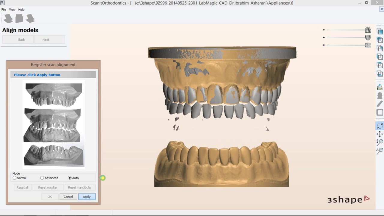 Digital Orthodontic Models Scanning - YouTube