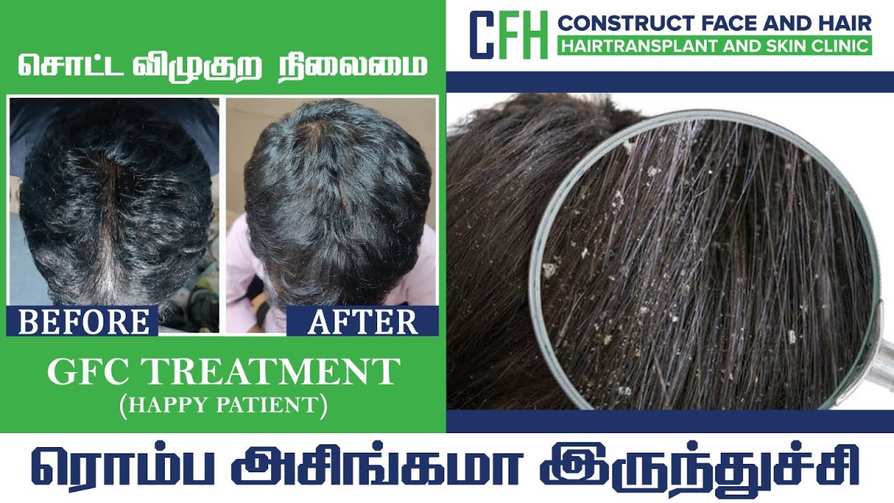 GFC result Patient Review | Construct Face and Hair transplant| Chennai ...