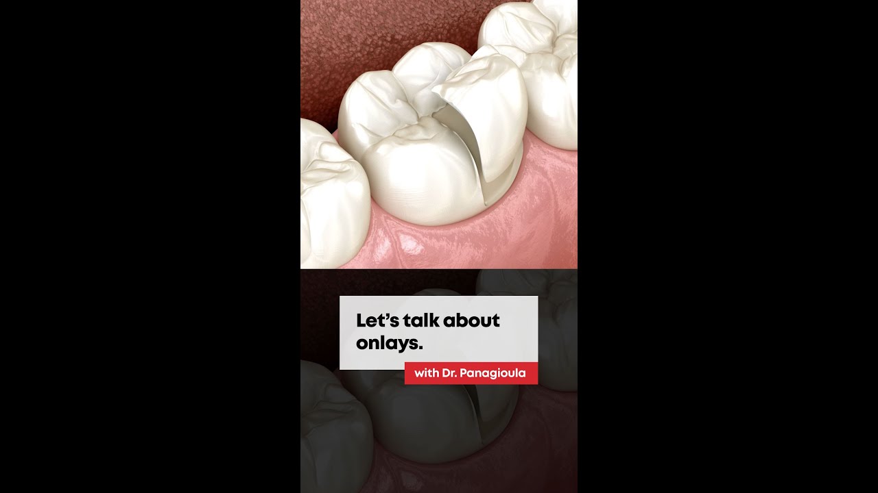 What are teeth onlays? - YouTube