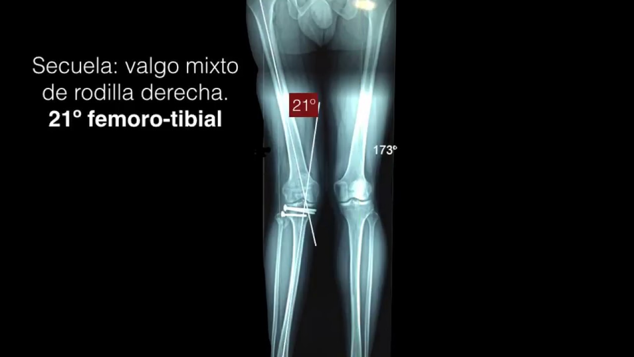 OSTEOTOMÍA FEMORAL Planeación preoperatorioa - YouTube