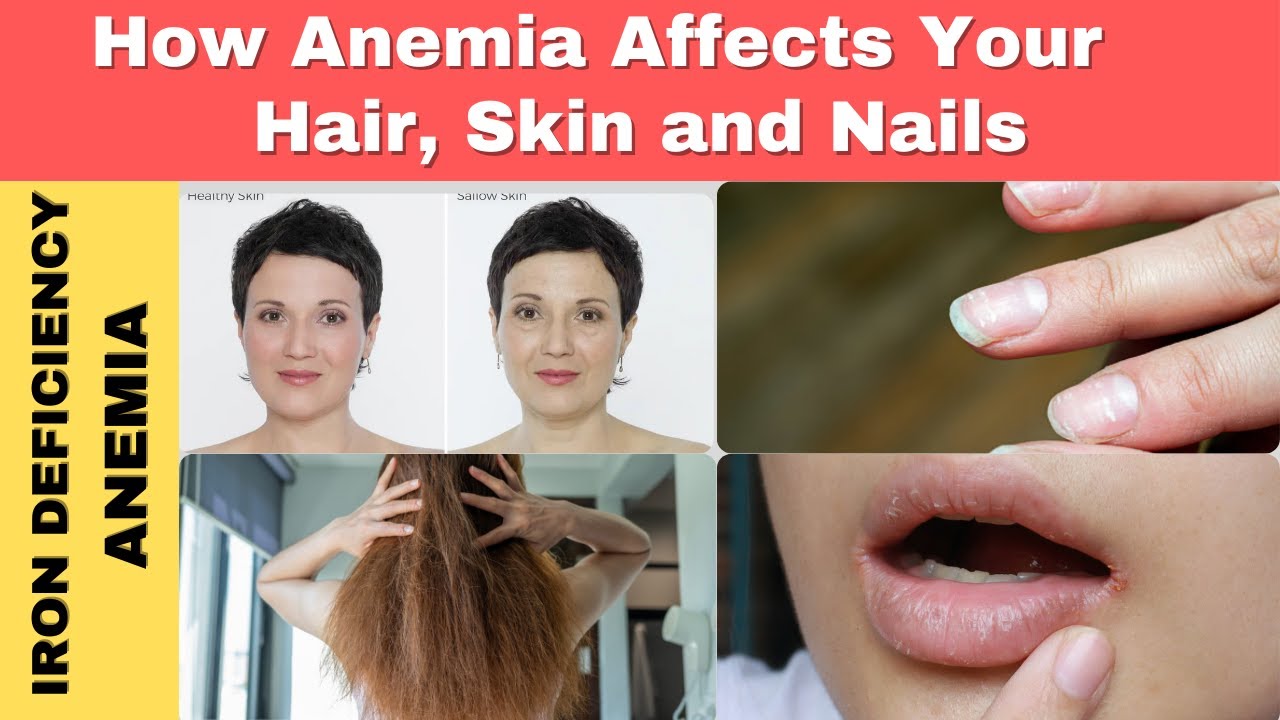How Iron Deficiency Anemia Affects Your Hair, Skin and Nails | Signs Of ...