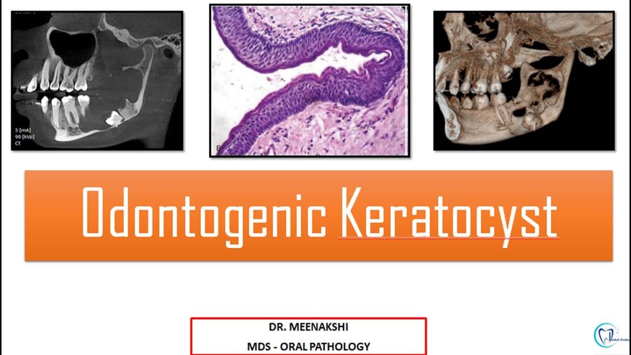 Odontogenic Keratocyst - YouTube