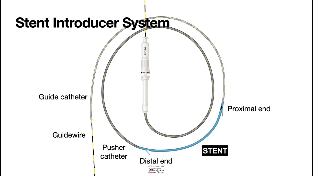 HCC 1474 -17d Biliary Plastic Stents Using a Stent Introducer System ...