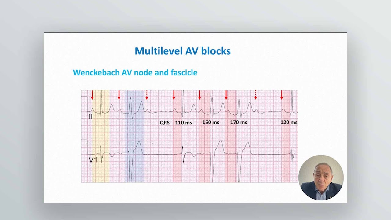 Masterclasses in Electrocardiography - Clinical Spectrum of High Degree ...