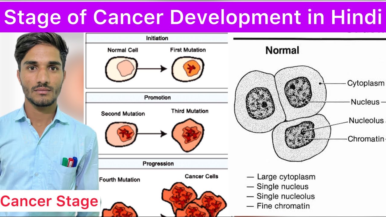 Stage of Cancer Development | Stage of Cancer | Cancer Stage | Cancer ...