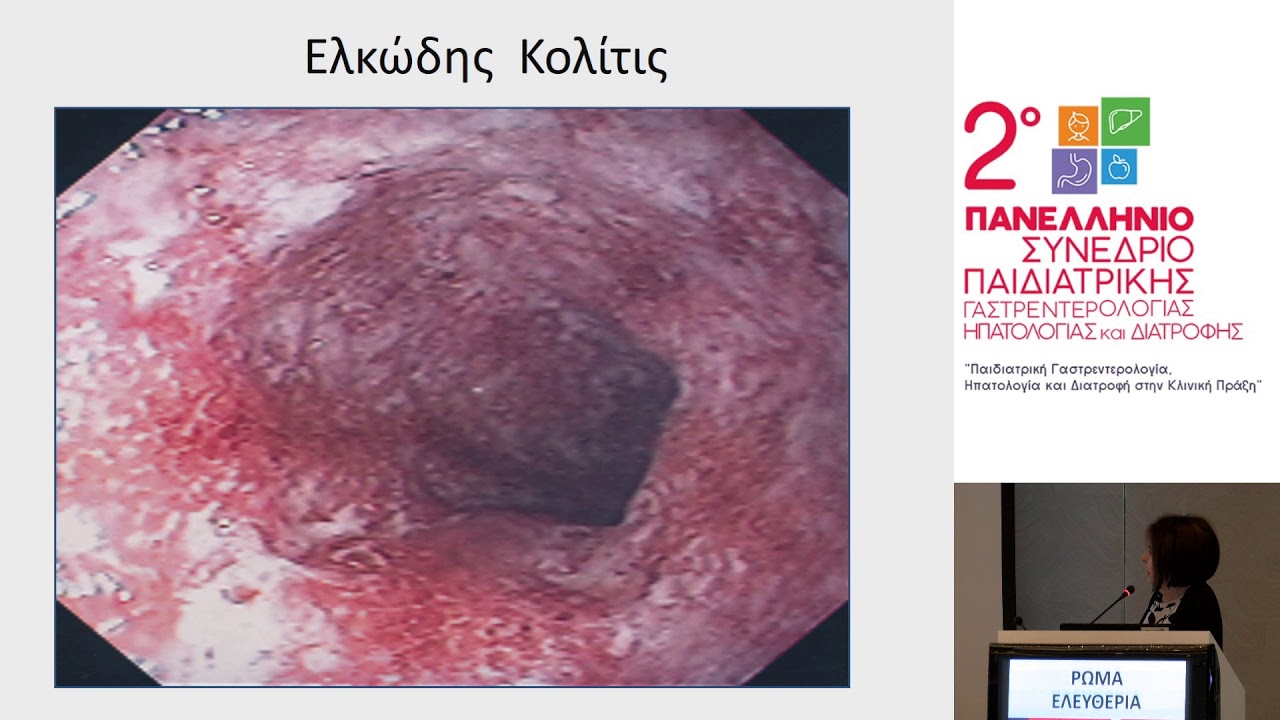 Ρώμα Ελευθερία | Φλεγμονώδης νόσος του εντέρου: Πότε θα την υποψιαστεί ...