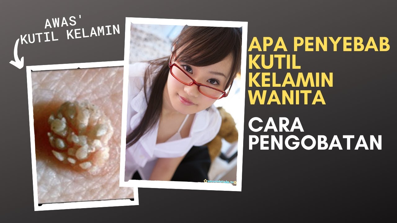 Apakah Penyebab Kutil Kelamin Wanita?? - Cara Pengobatan - YouTube