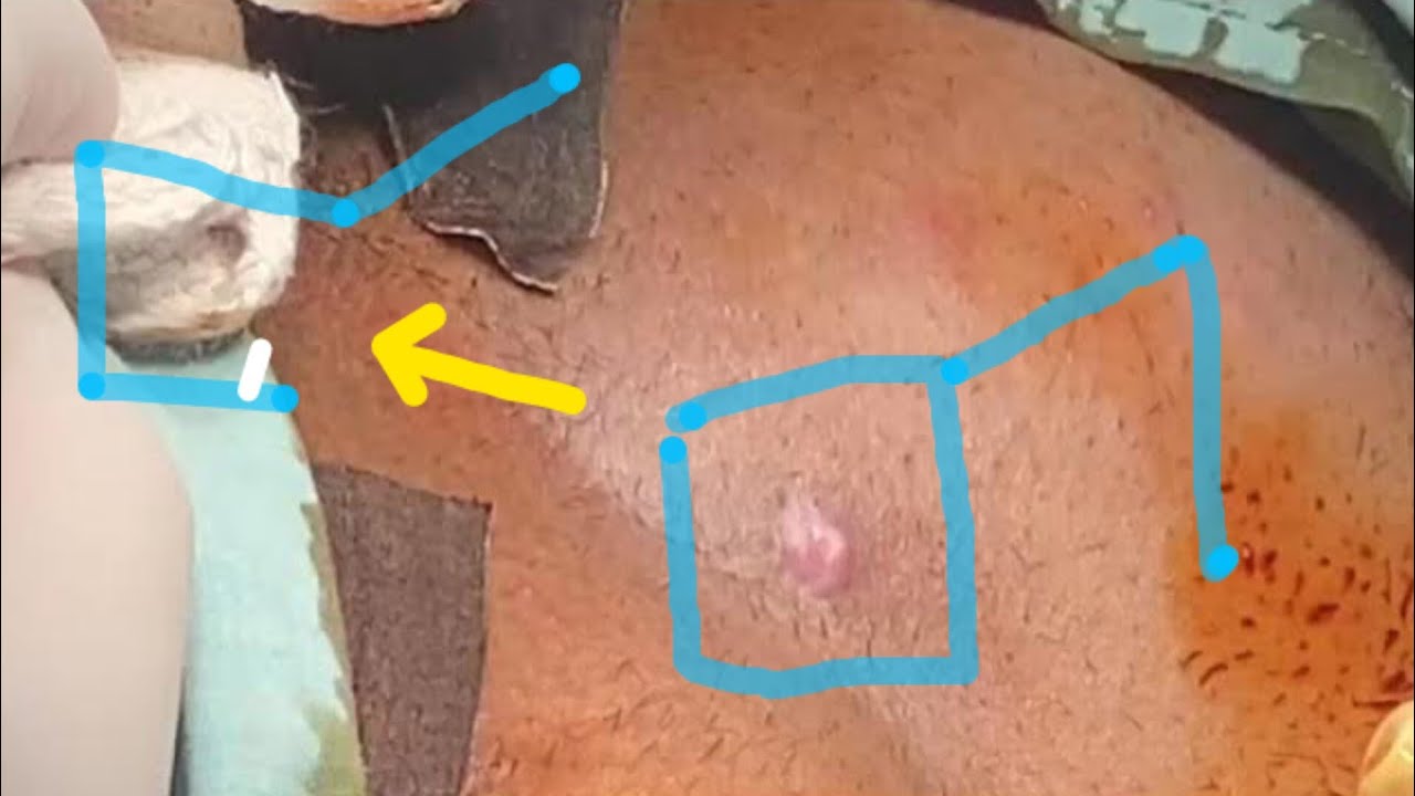 Limberg flap / rhomboid flap / flaps in pilonidal surgery - YouTube