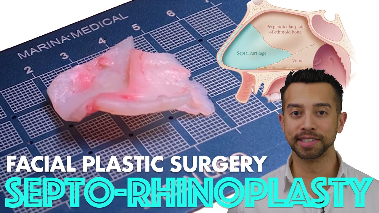 Septo-Rhinoplasty | Dr. Giriraj Sharma | Newport Beach, CA - YouTube