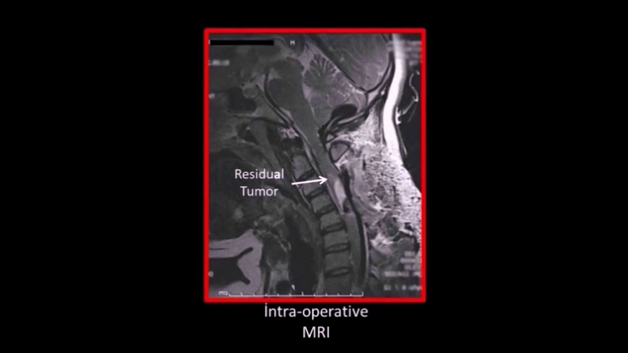 Cervical Spinal Cord Tumor