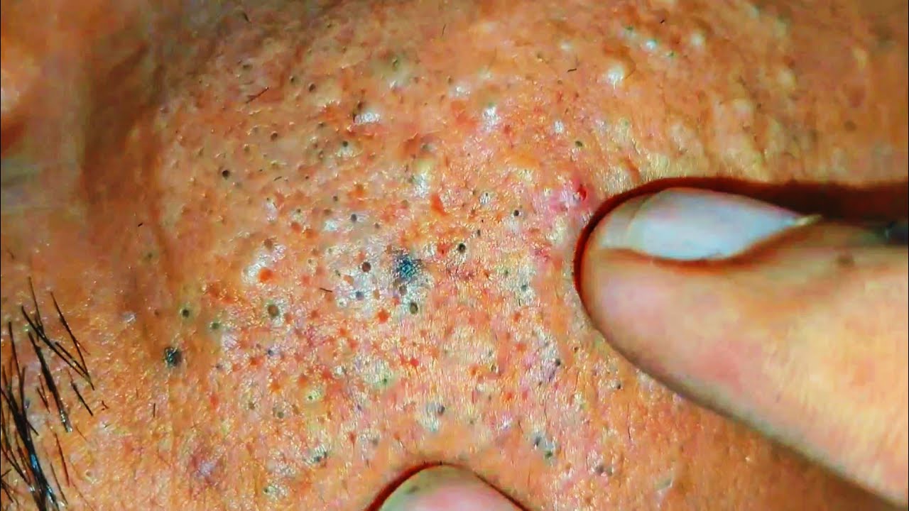 sac be spa blackheads elderly real | sac be spa boy age blackheads new ...