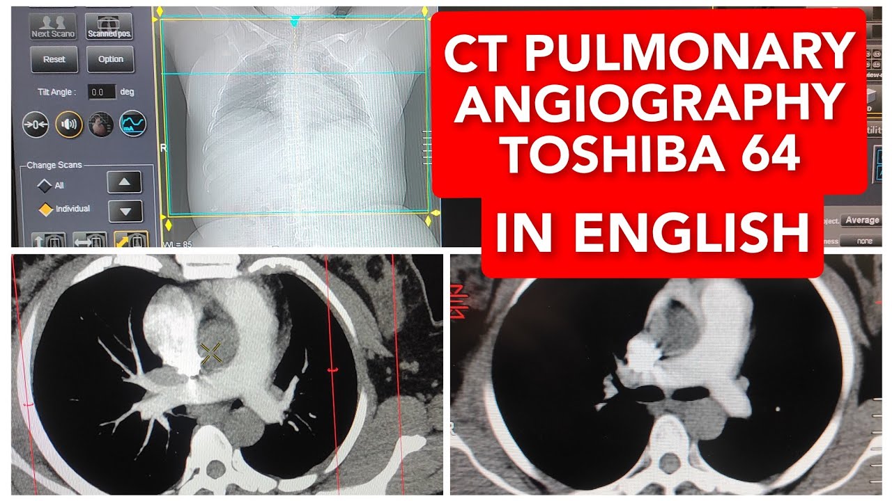 CT Pulmonary Angiography on Toshiba 64 Slice. - YouTube