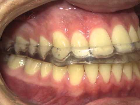 PLACA OCLUSAL ESTABILIZADORA.wmv - YouTube